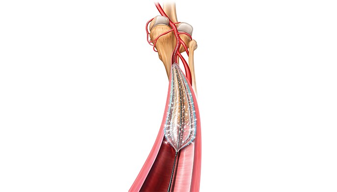 LUTONIX 014 DCB CATHETER 5FR 2MM X 120MM - 9040515200120 | BD