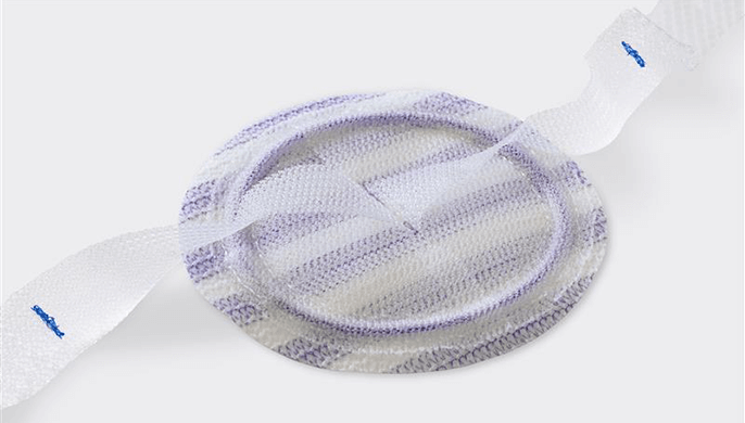 Phasix™ ST Umbilical Hernia Patch, Medium Circle with Strap, 2.5 in (6. ...