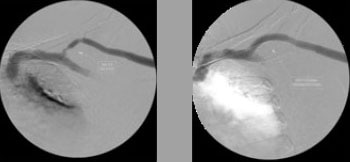Covera™ Vascular Covered Stent | AV Patients | BD