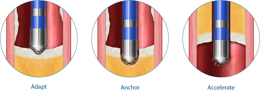 Crosser iQ™ Ultrasonic CTO Device