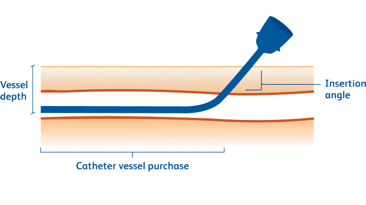 PowerGlide™ Midline Catheters | BD