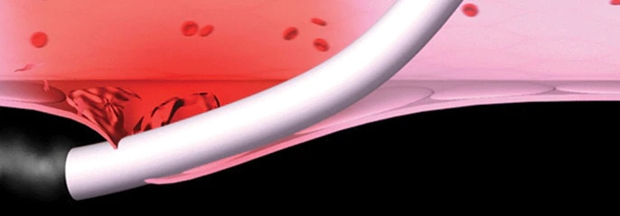 Gestión del acceso vascular